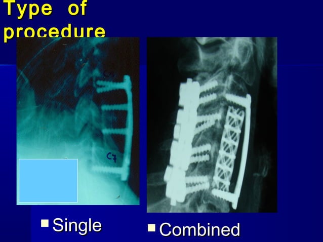 Late Post-operative Spinal Infections | PPT