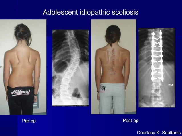 Late Post-operative Spinal Infections | PPT