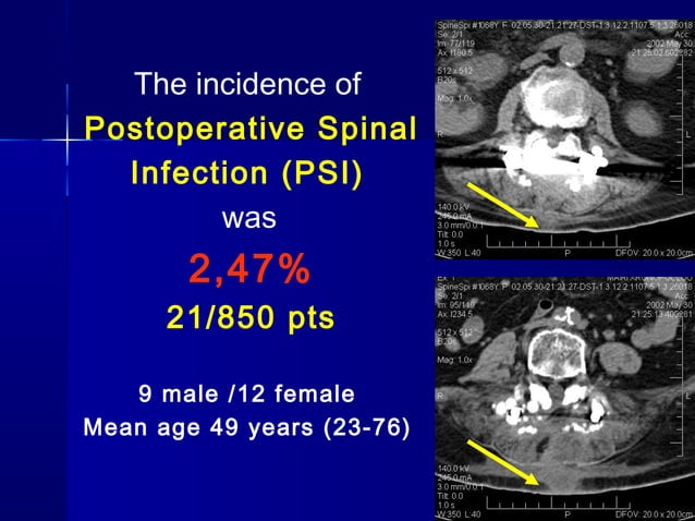 Late Post-operative Spinal Infections | PPT