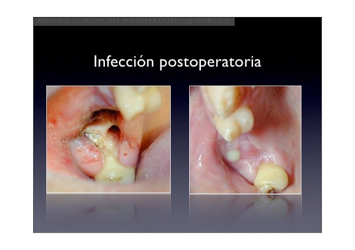 Postoperatorio ClíNico 2