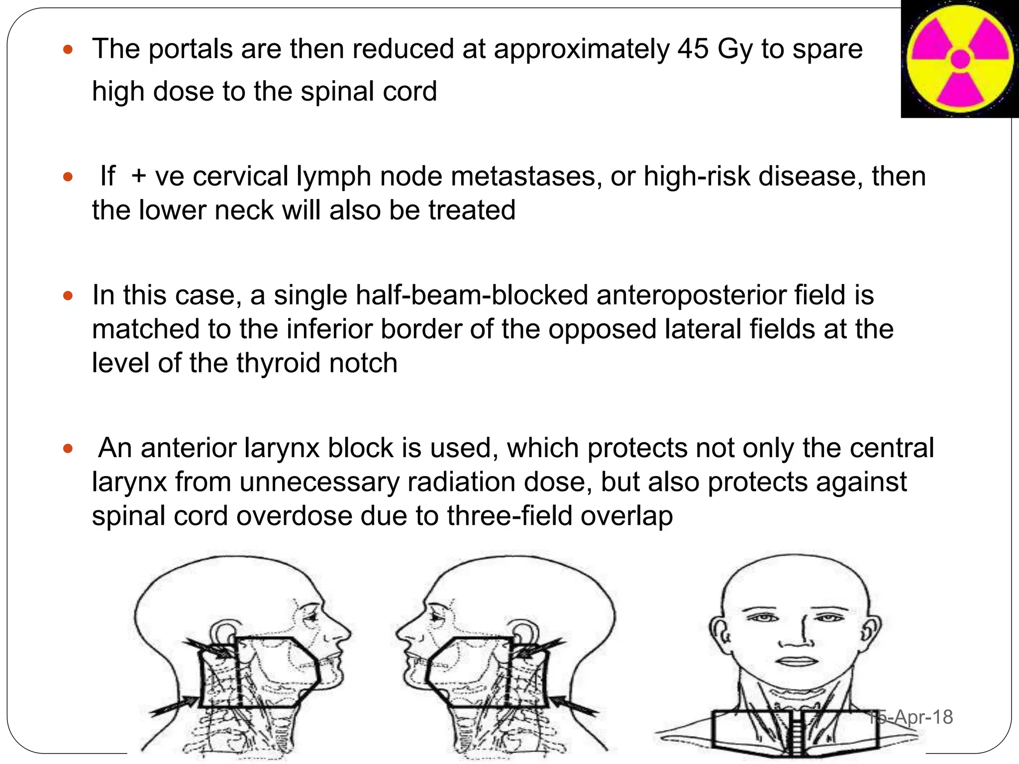Post op radiotherapy in oral cavity cancers | PPTX