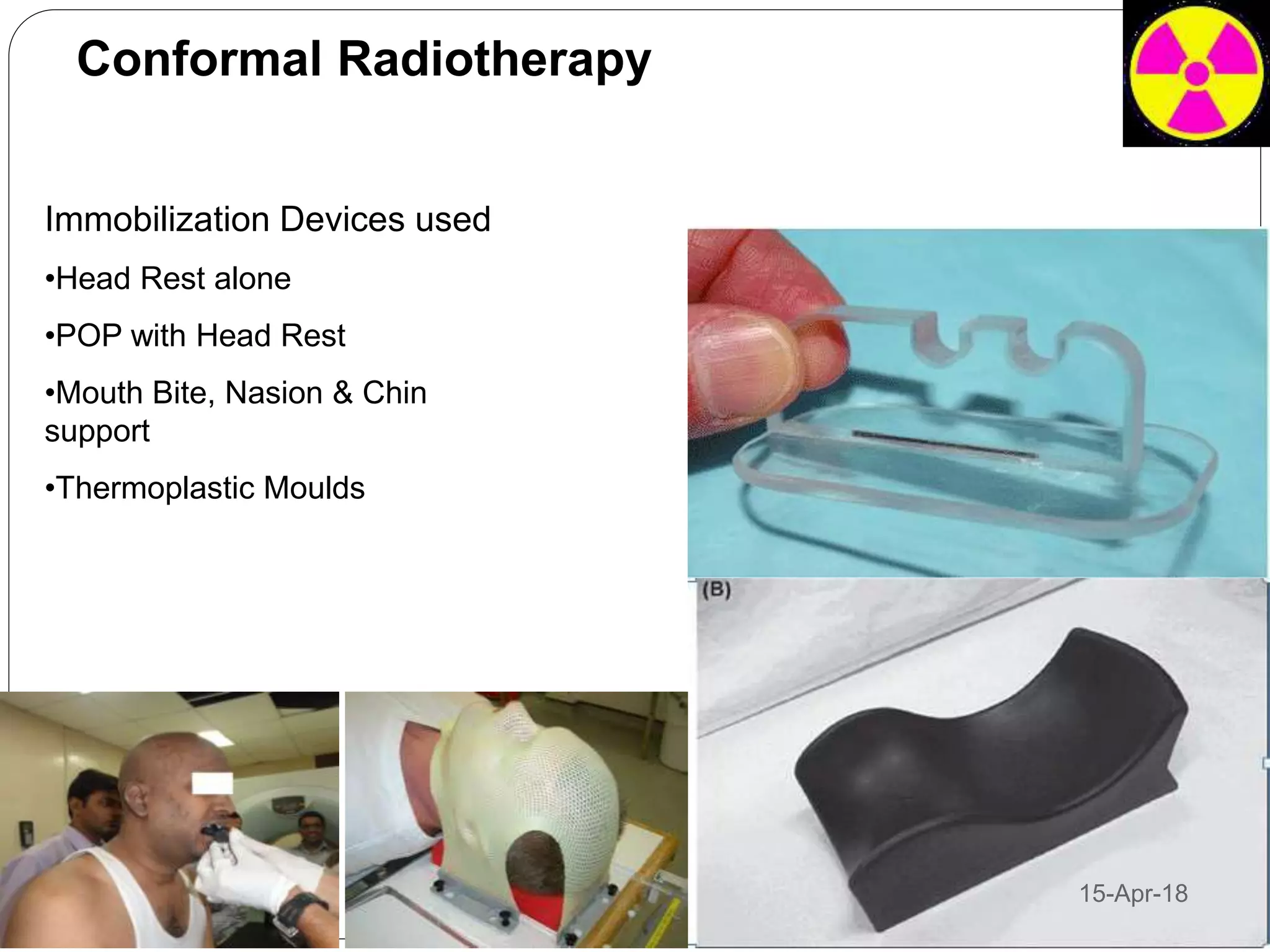 Post op radiotherapy in oral cavity cancers | PPTX