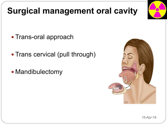 Post op radiotherapy in oral cavity cancers | PPTX | Ear, Nose and ...