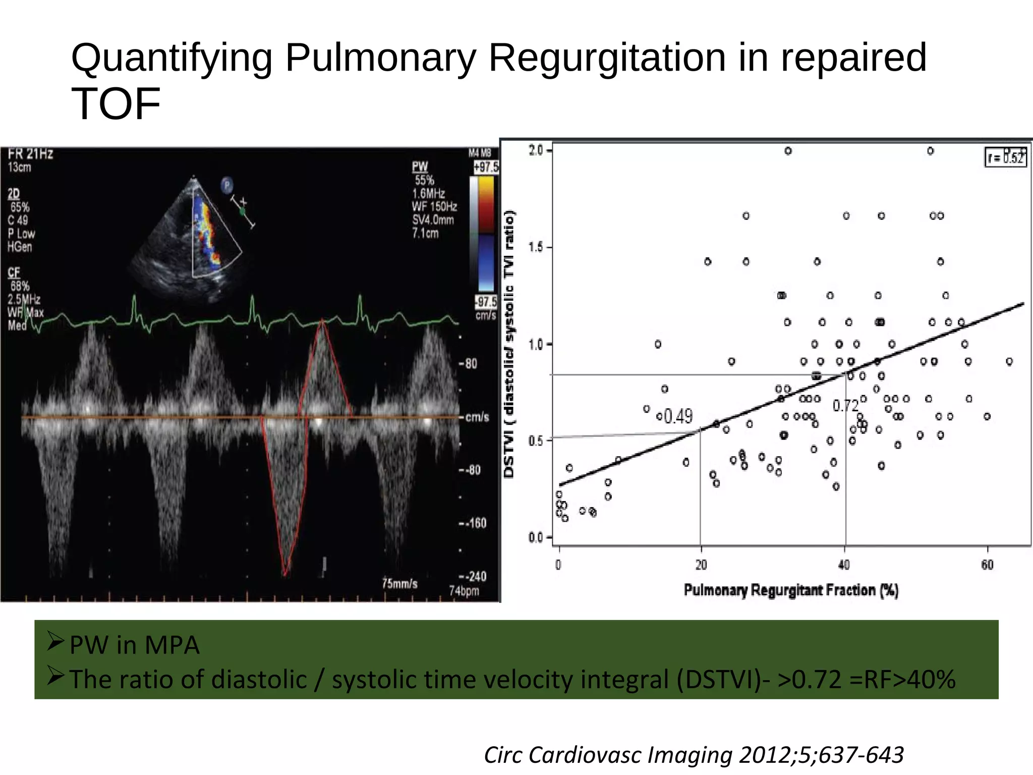 Post op tetrology of fallot (TOF) | PPT
