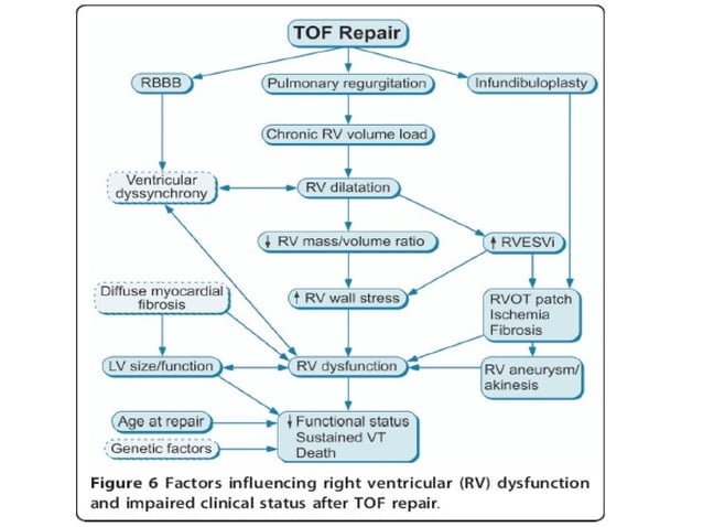 Post op tetrology of fallot (TOF) | PPT