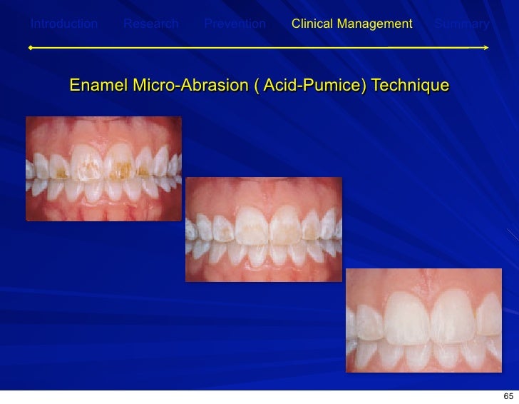 Post Orthodontic Demineralization: Recommendations for Prevention and…