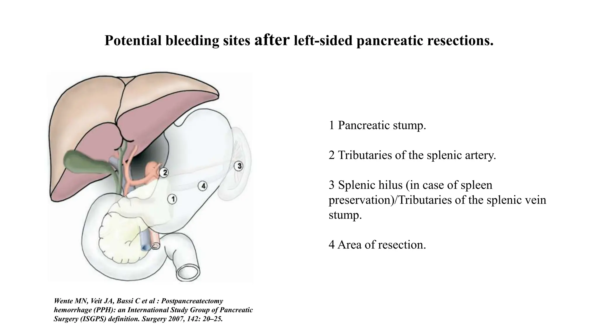 Post pancreaticoduodenectomy hemorrhage (PPH) | PPTX