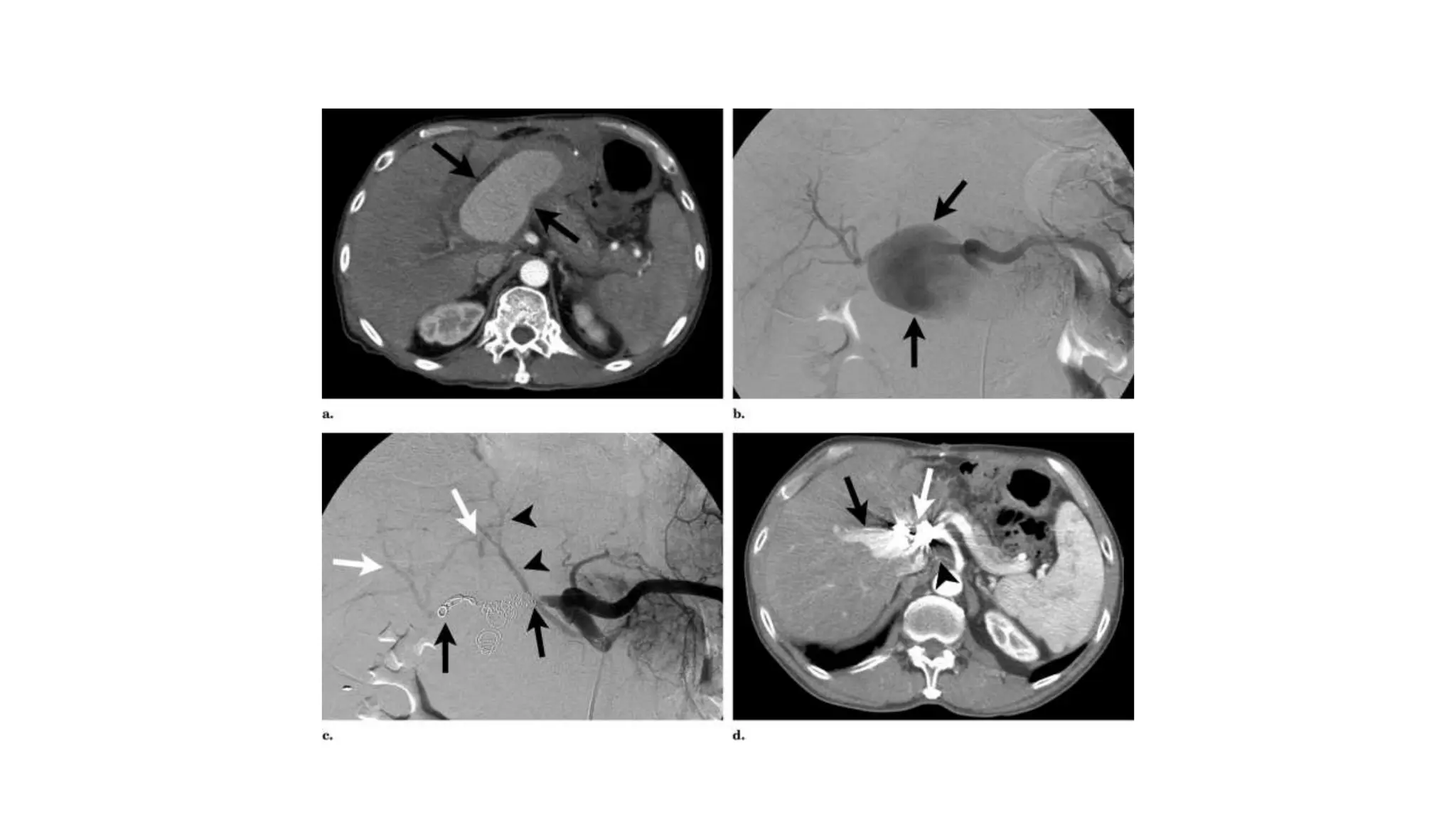Post pancreaticoduodenectomy hemorrhage (PPH) | PPTX