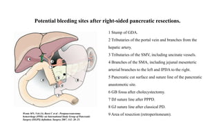 Post pancreaticoduodenectomy hemorrhage (PPH) | PPTX
