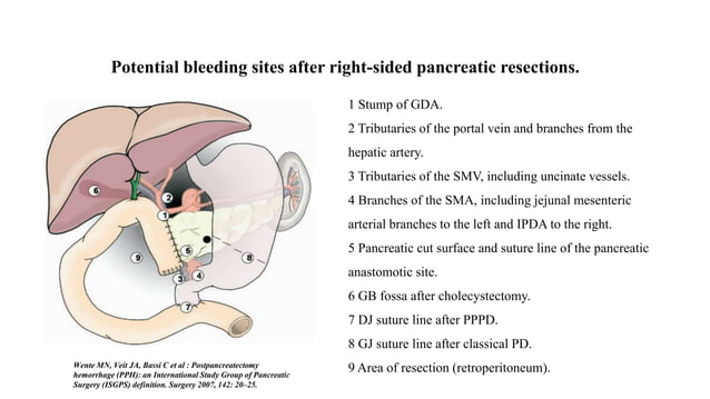 Post pancreaticoduodenectomy hemorrhage (PPH) | PPTX | Blood Disorders ...