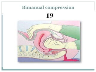 postpartum collapse | PPTX