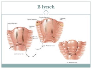 postpartum collapse | PPTX