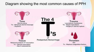 POSTPARTUM HAEMORRHAGE.pptx