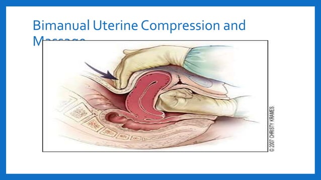 PPH Bundle.pptx | Pregnancy | Reproductive Health