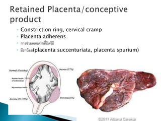 Postpartum hemorrhage | PPTX