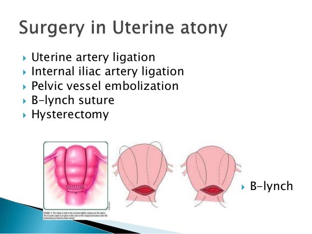 Postpartum hemorrhage