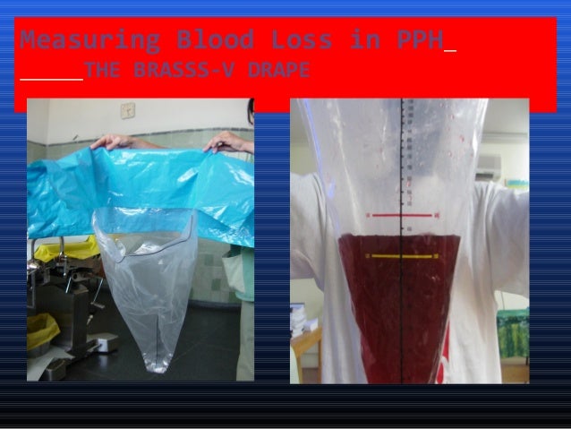 Postpartum hemorrhage for undergraduate