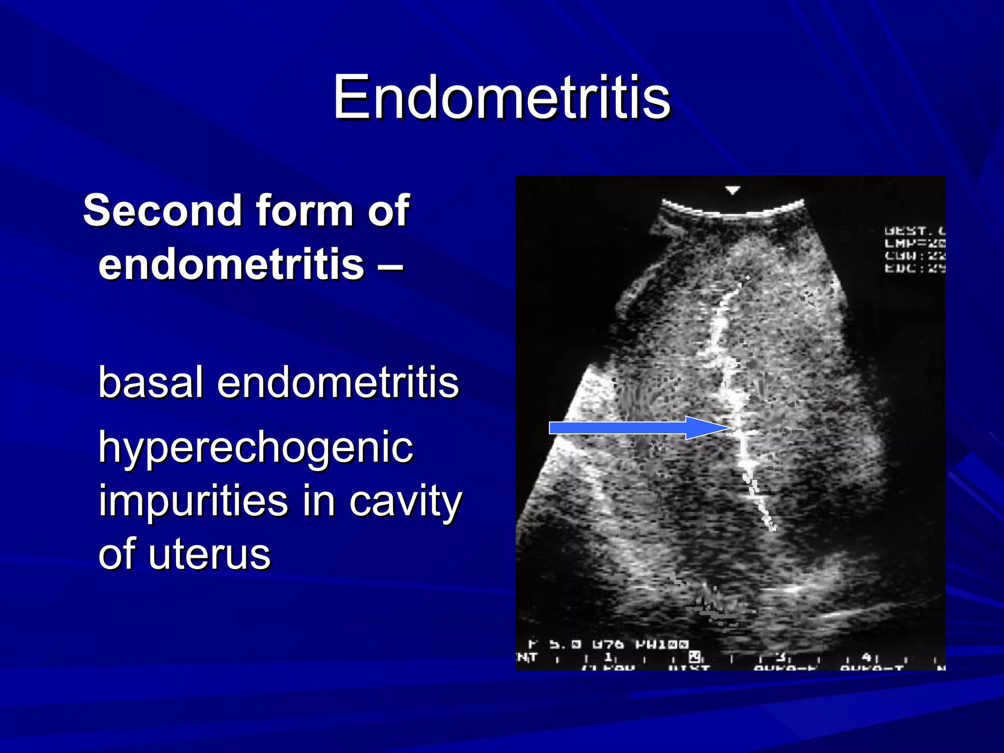 Postpartum Infections | PPT