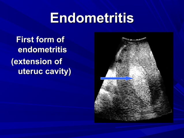 Postpartum Infections | PPT | Pregnancy | Reproductive Health