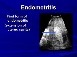 Postpartum Endometritis
