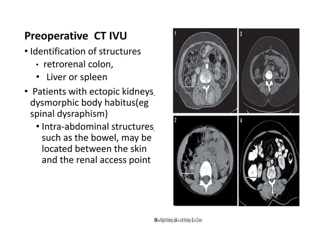 post pcnl complications.pptx