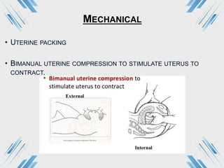 postpartum hemorrhage | PPT