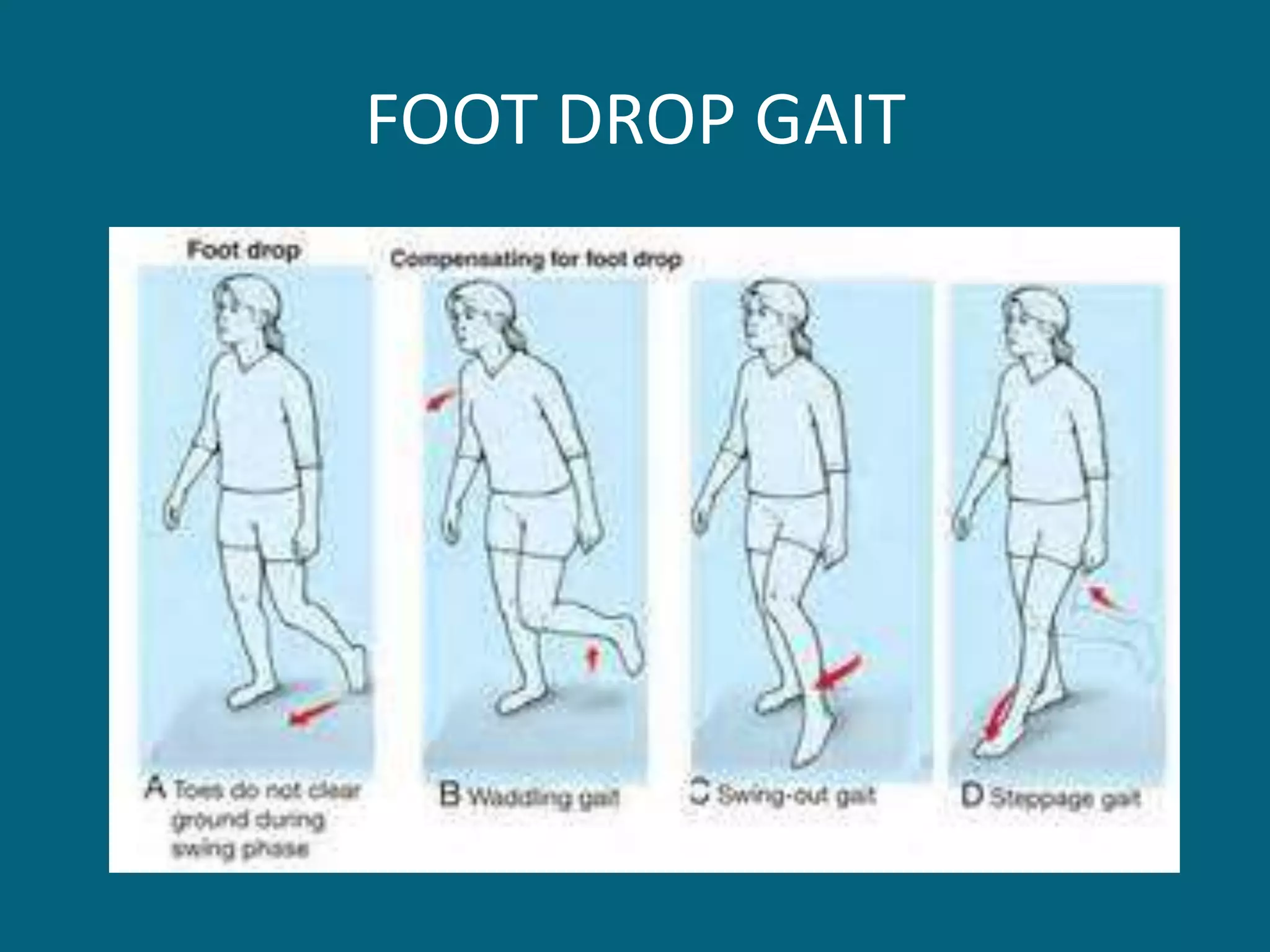 Post polio residual paralysis PPT | PPTX