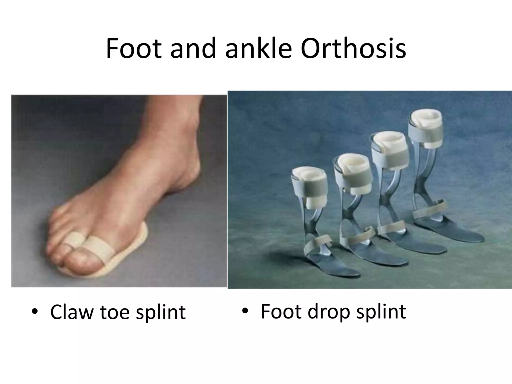 Post Polio Residual Paralysis | PPTX