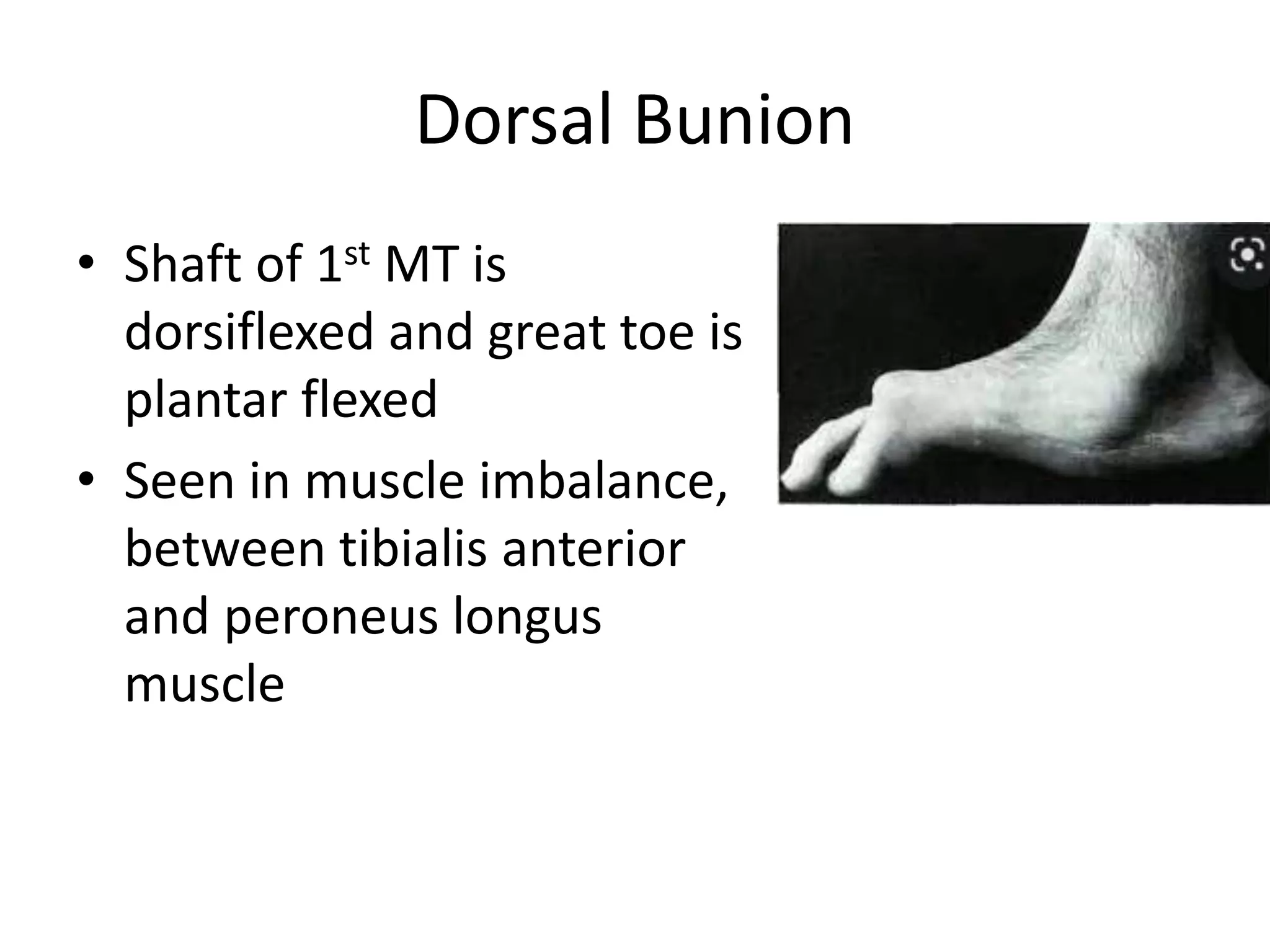 Post Polio Residual Paralysis | PPTX