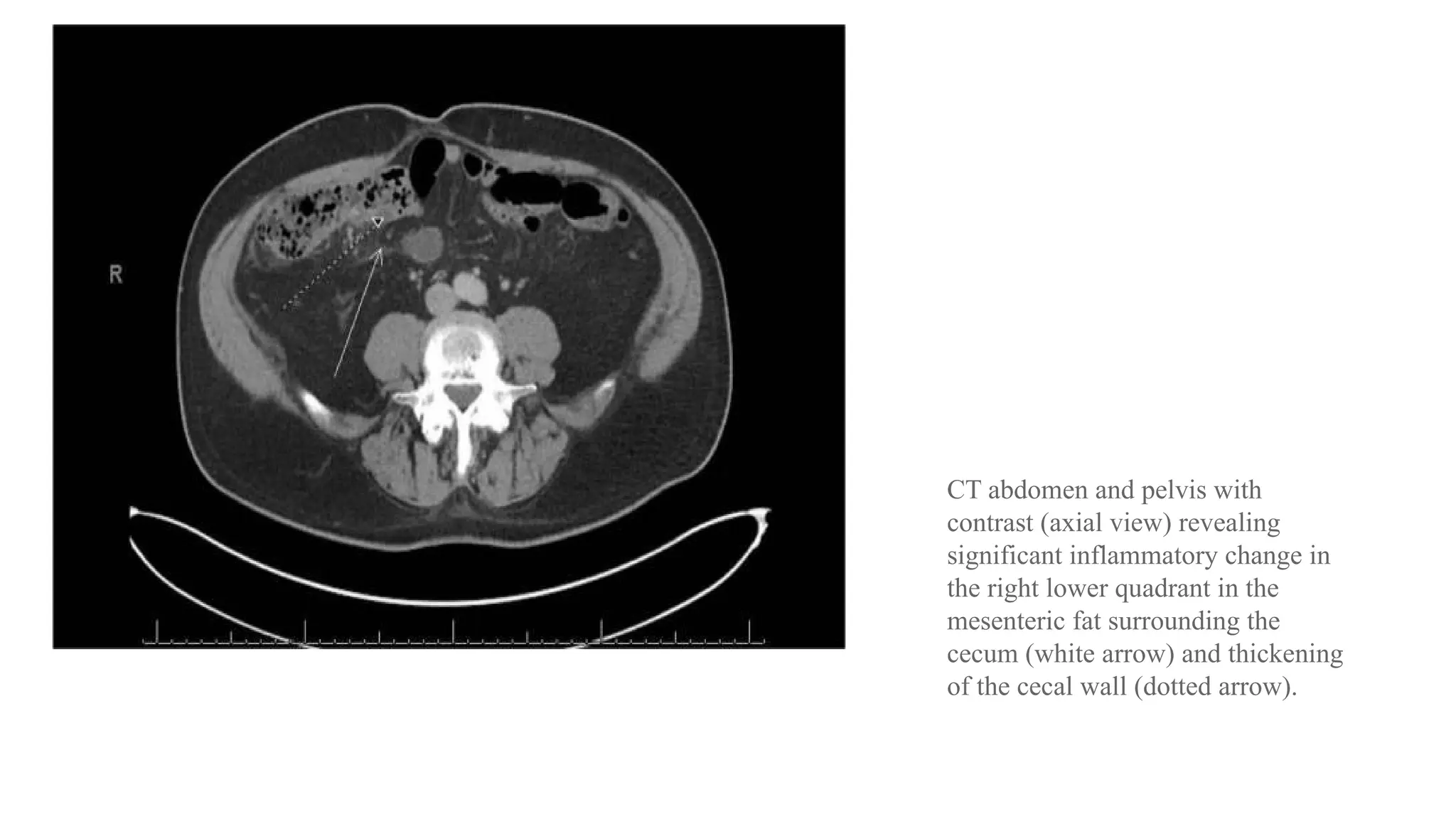 POST POLYPECTOMY SYNDROME-APPROACH AND MANAGEMENT | PPTX