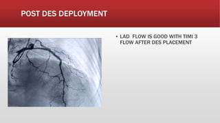 POST PRANDIAL ANGINA WITH DOUBLE VESSEL DISEASE ,TOTAL OCCLUSION OF ...