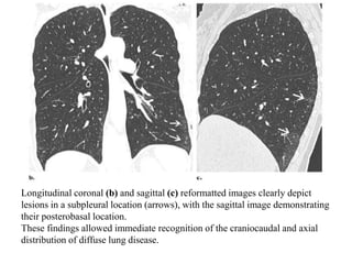 Post Processing of CT Thorax | PPTX