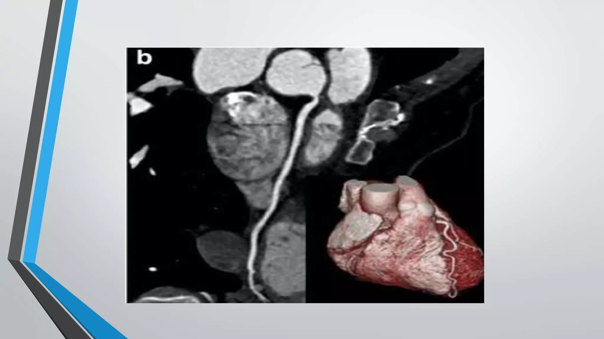 Post processing of computed tomography | PPTX