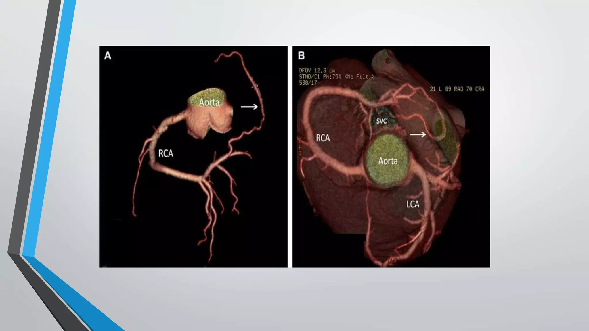 Post processing of computed tomography | PPTX