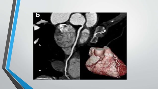 Post processing of computed tomography | PPTX