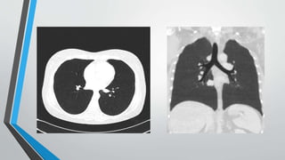 Post processing of computed tomography | PPTX