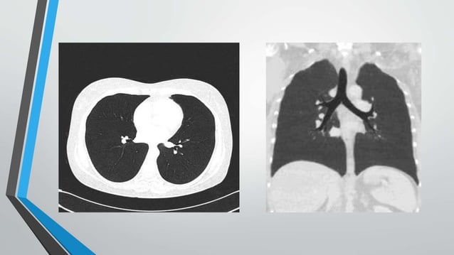 Post processing of computed tomography | PPTX