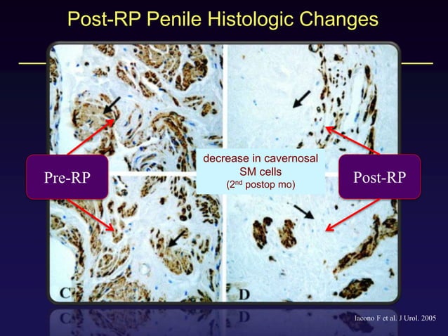Postprostatectomy sexual dysfunction is restoring erections enough ...
