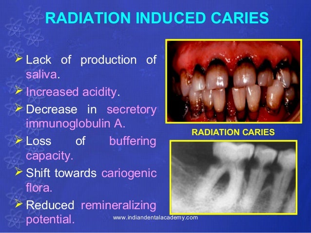 Post radiation complications/ dental courses