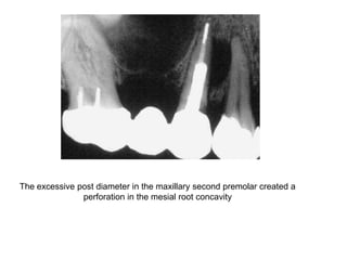 Post retained endodontic restorations | PDF