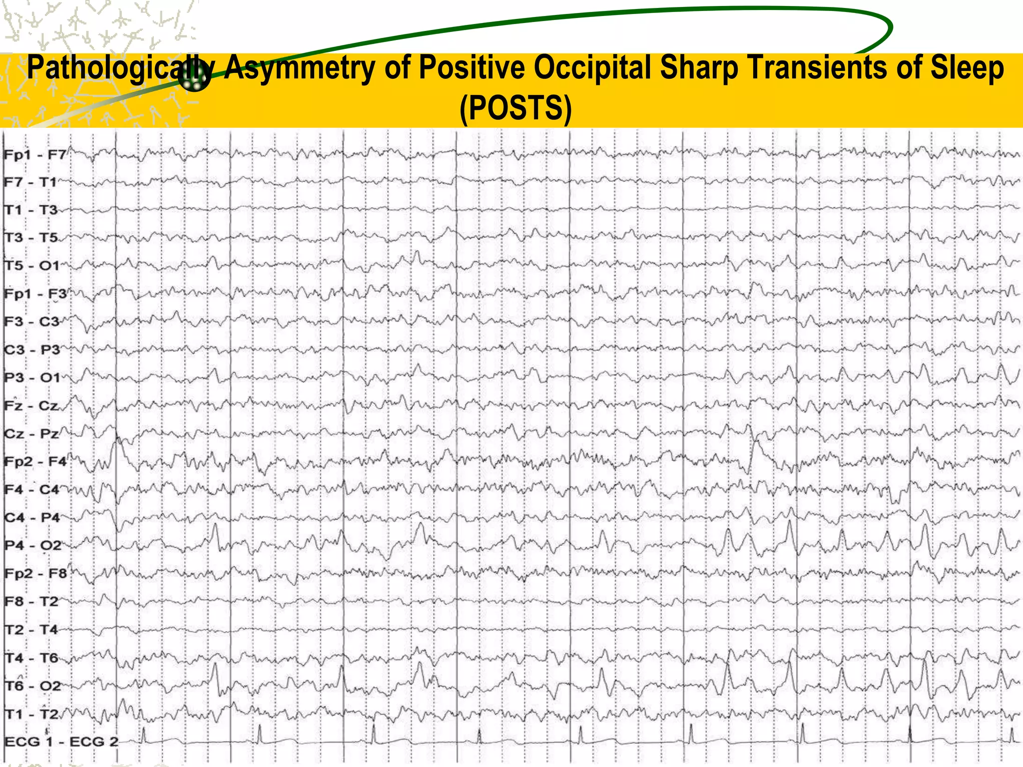 Positive Occipital Sharp Transients of Sleep, Posterior slow-wave ...