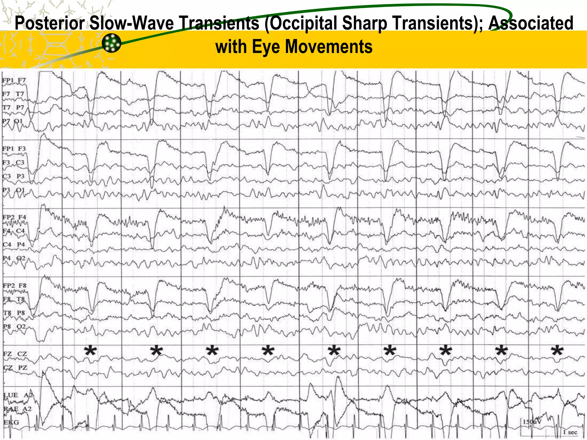 Positive Occipital Sharp Transients of Sleep, Posterior slow-wave transients associated with eye ...