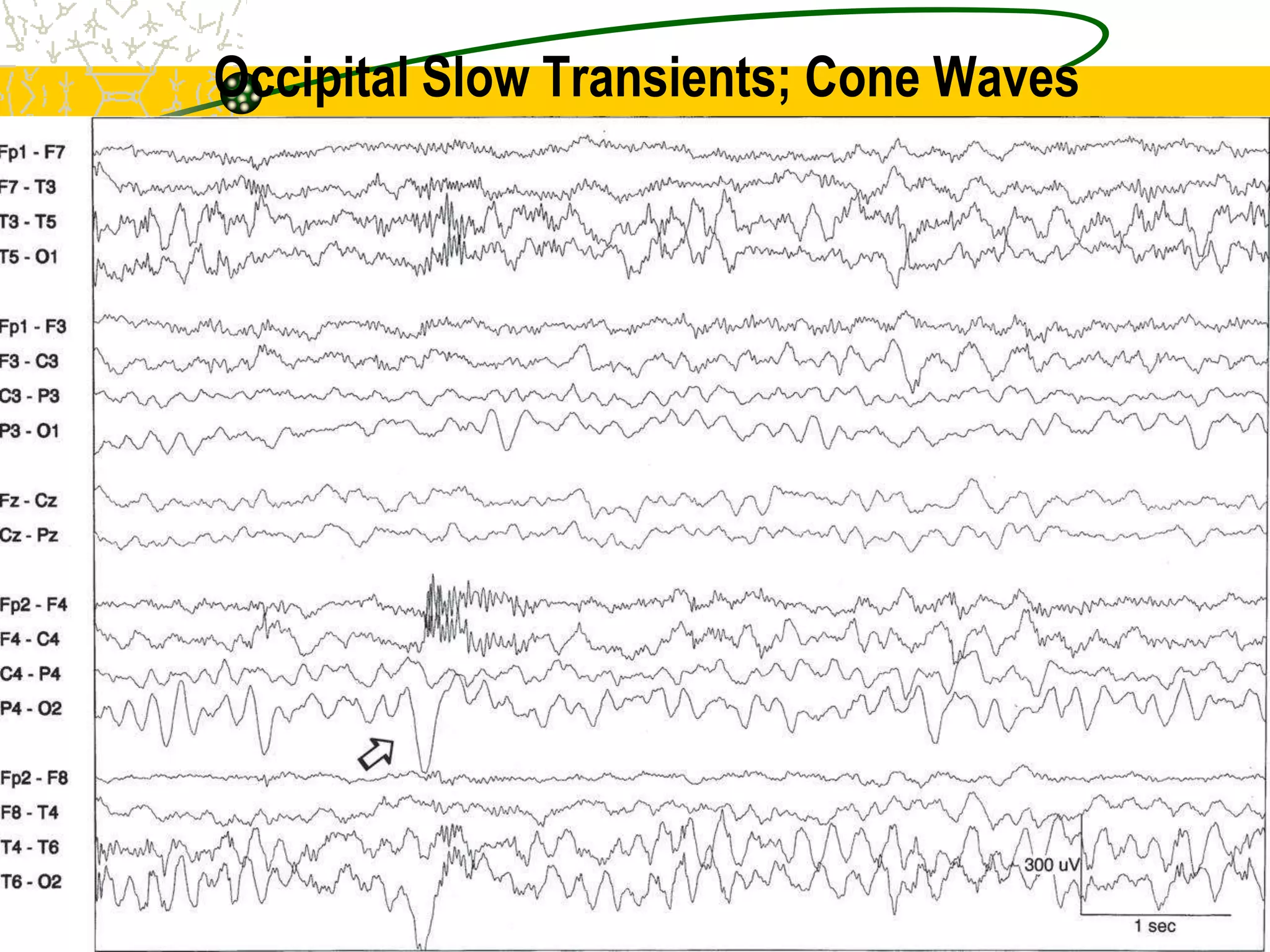 Positive Occipital Sharp Transients of Sleep, Posterior slow-wave ...