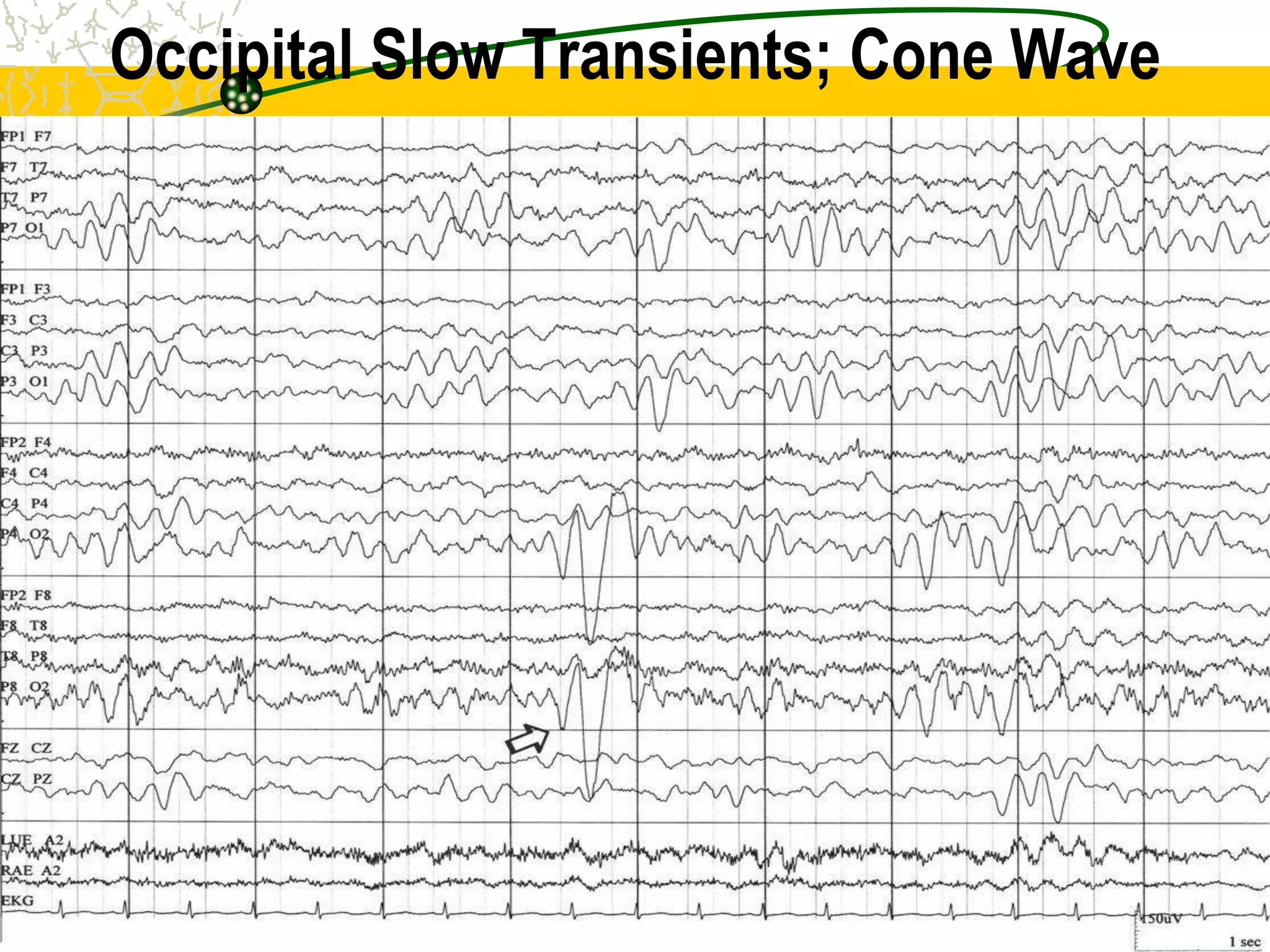 Positive Occipital Sharp Transients of Sleep, Posterior slow-wave ...