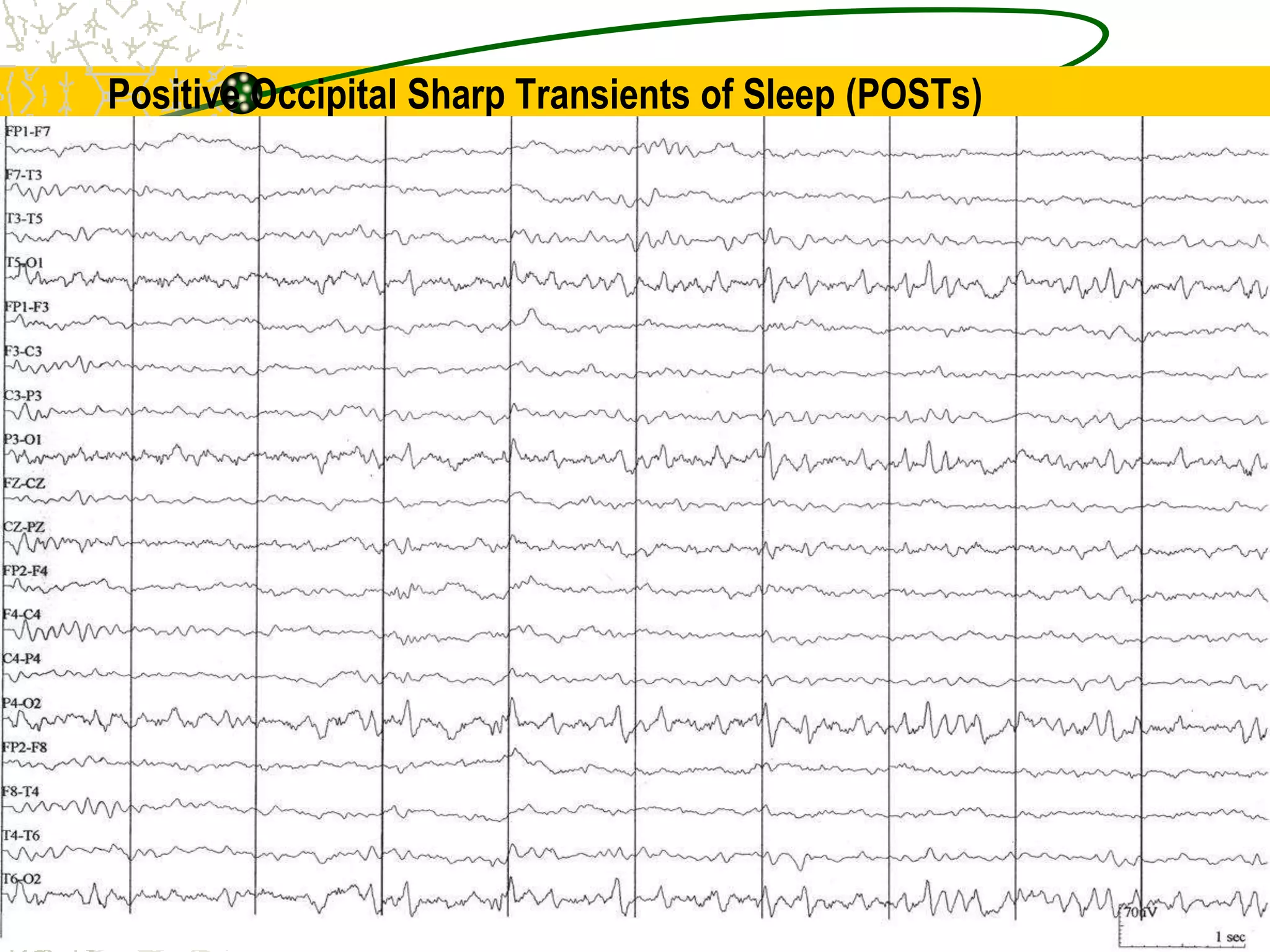 Positive Occipital Sharp Transients of Sleep, Posterior slow-wave ...