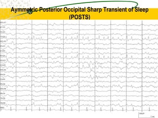 Positive Occipital Sharp Transients of Sleep, Posterior slow-wave ...