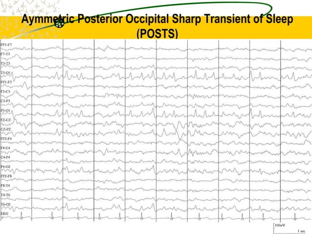 Positive Occipital Sharp Transients of Sleep, Posterior slow-wave ...