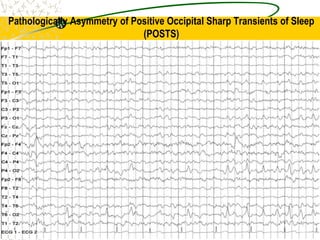Positive Occipital Sharp Transients of Sleep, Posterior slow-wave ...