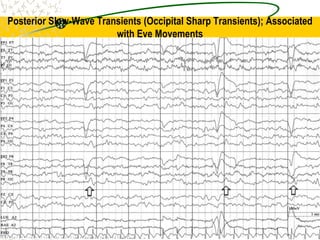 Positive Occipital Sharp Transients of Sleep, Posterior slow-wave ...