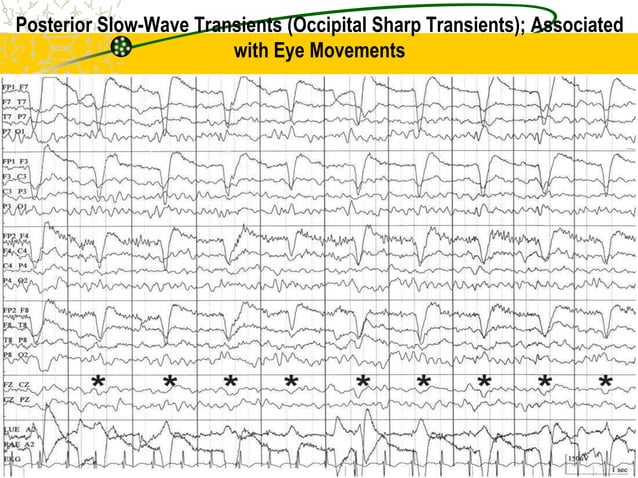 Positive Occipital Sharp Transients of Sleep, Posterior slow-wave ...